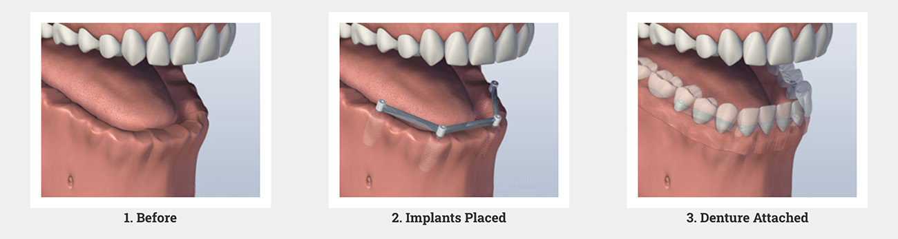 Implant Supported Dentures Pearl, MS | Brandon, MS